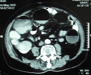 Cancerul de colon stang - Teodor Buliga