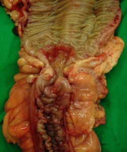 Cancerul de colon stang - Teodor Buliga