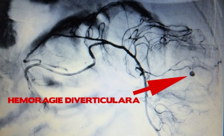 Diverticuloza colonica - simptome, complicatii, tratament - Dr. Teodor ...